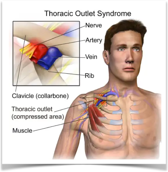 Thoracic Outlet Syndrome | Refine Health