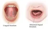 Frenectomy/Tongue-Tie Release — Honolulu Oral & Maxillofacial Surgery