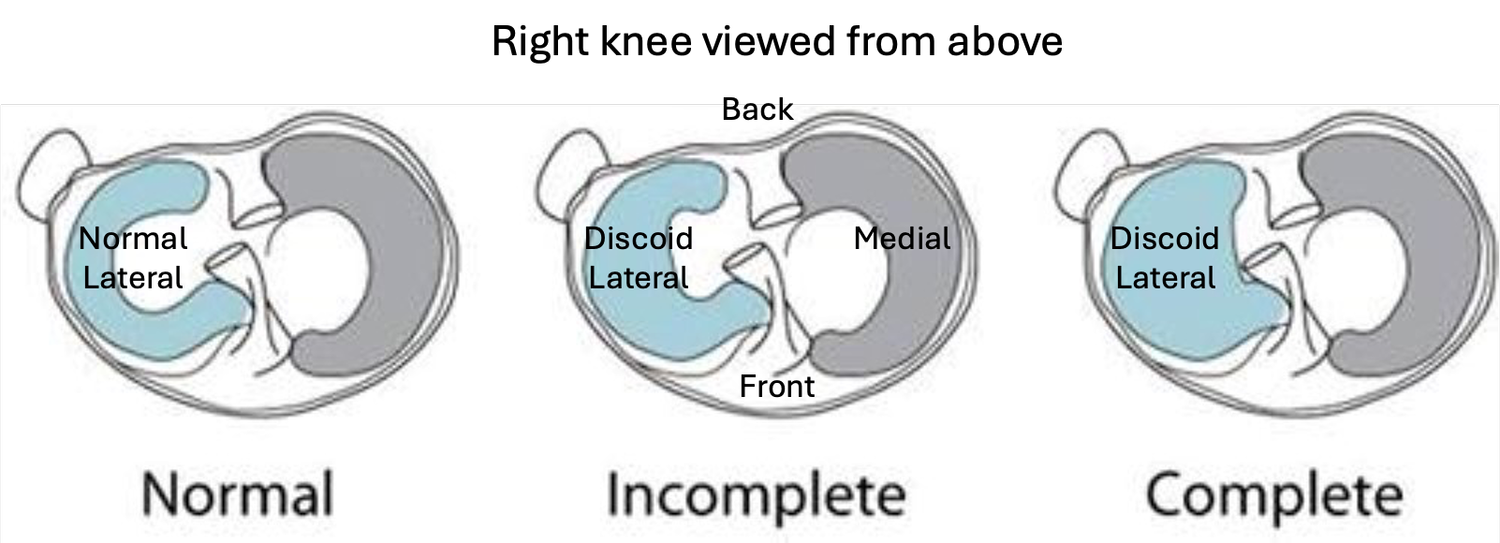 Discoid meniscus | Explore Treatment Options Today — Chinmay Gupte