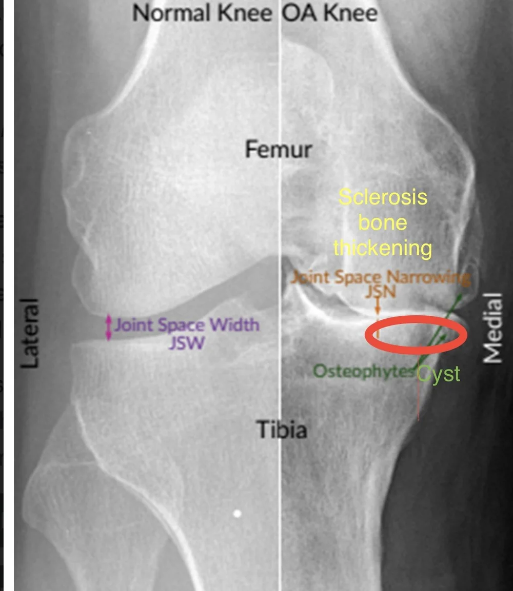 knee osteoarthritis London — Chinmay Gupte