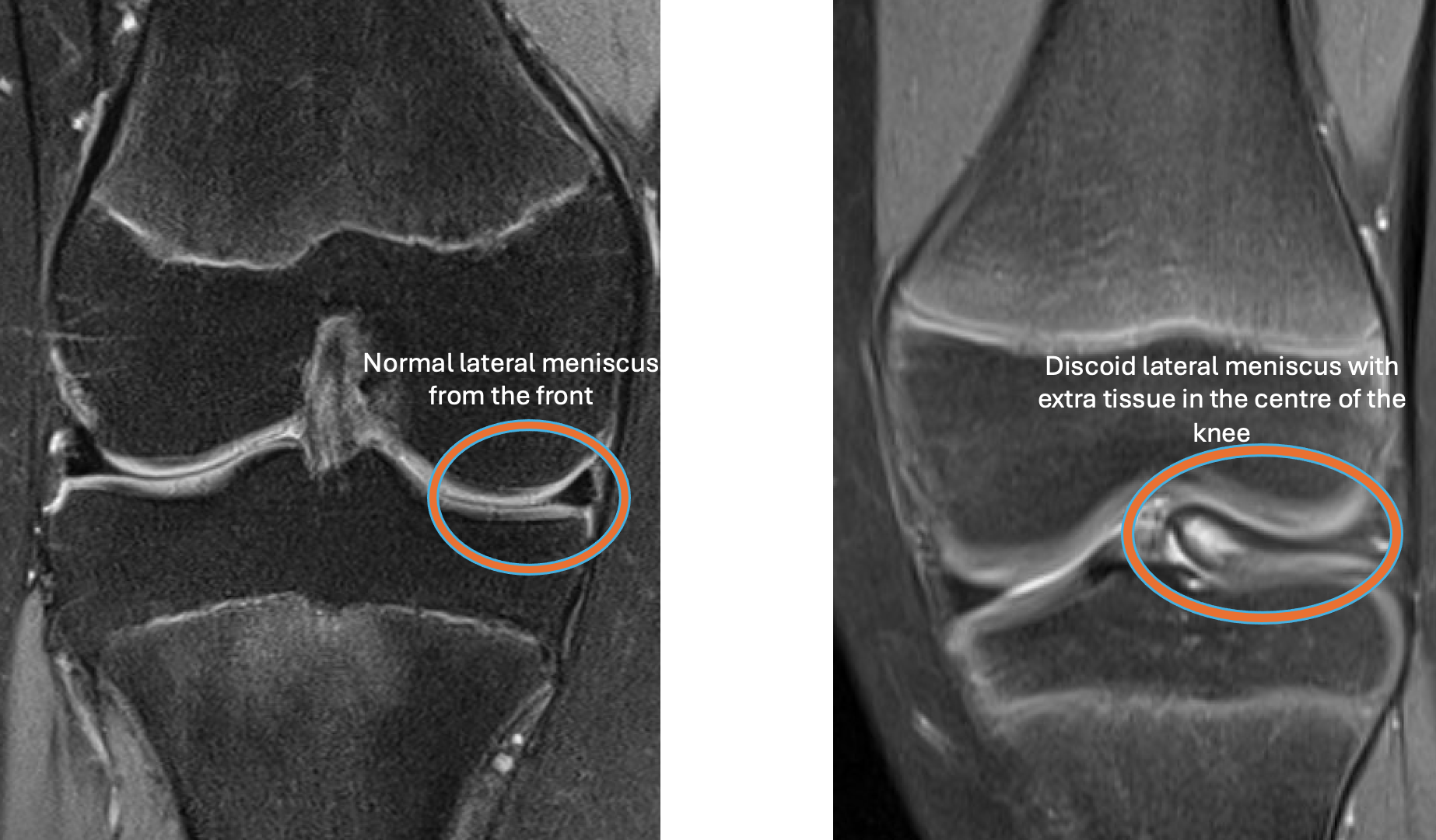 Discoid meniscus — Chinmay Gupte
