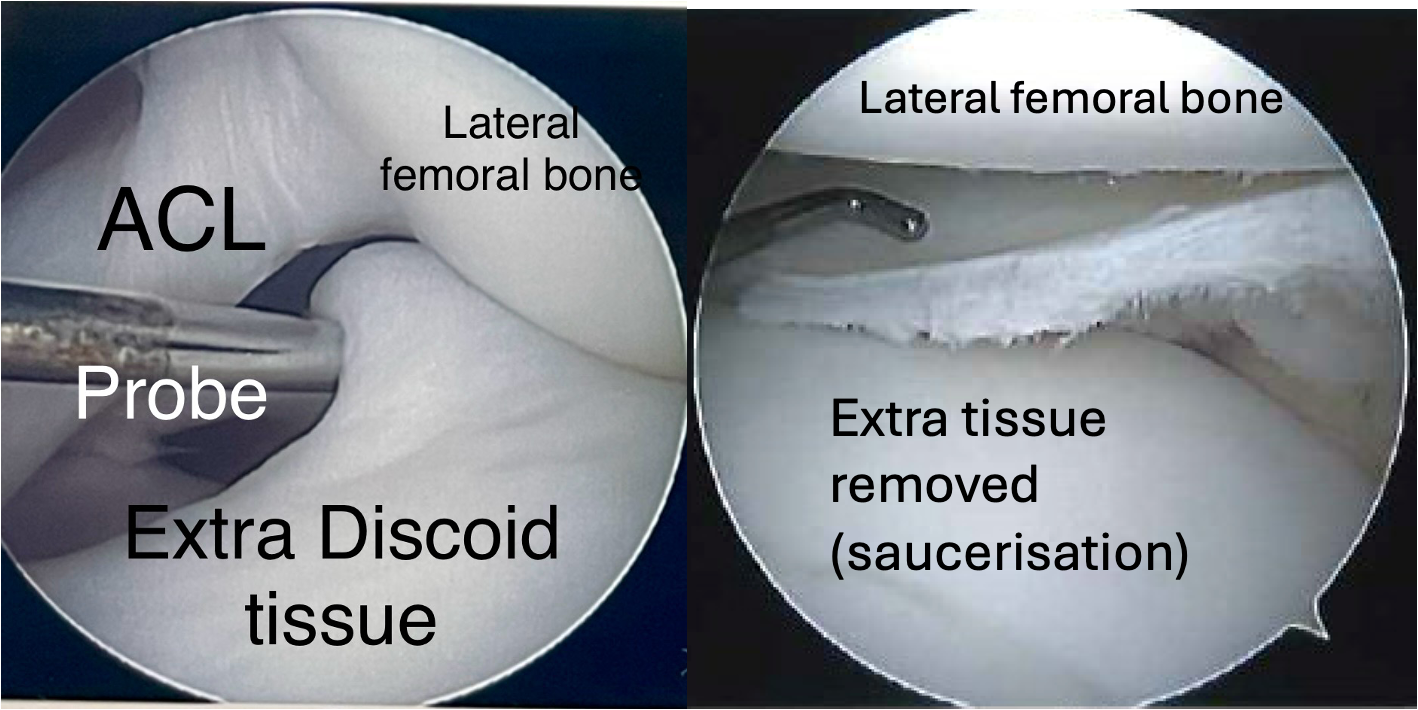 Discoid Meniscus Chinmay Gupte Discoid Meniscus Chinmay Gupte