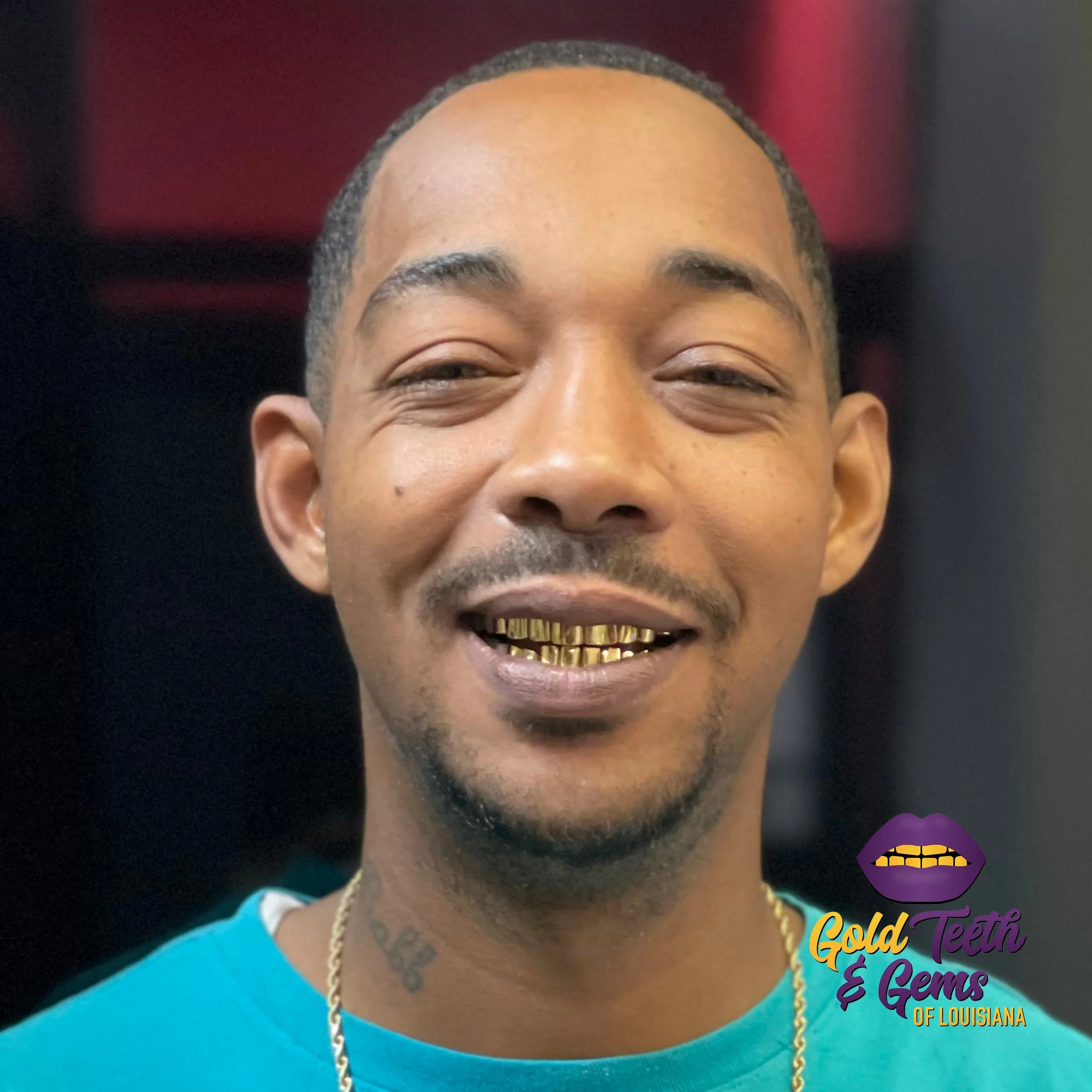 Permanent Gold Teeth