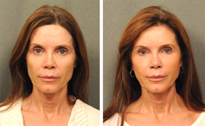 What is Fat Grafting? | Fat Grafting Recovery Time | Fat Grafting ...