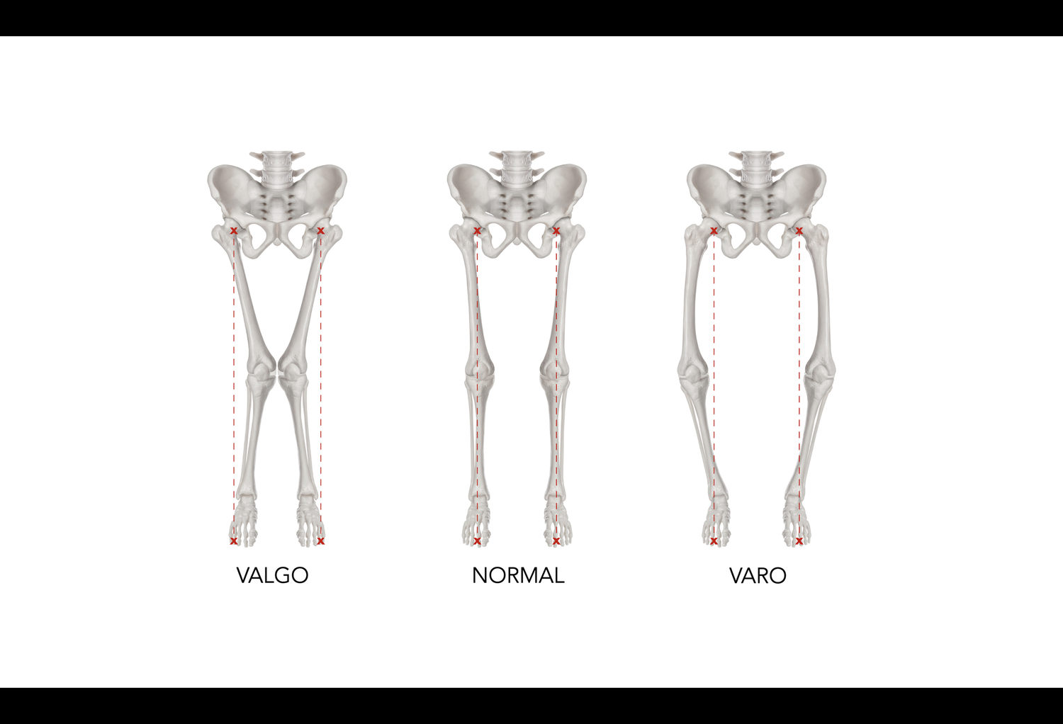 Osteotomía — Dr. Carlos Ferrer Señoráns