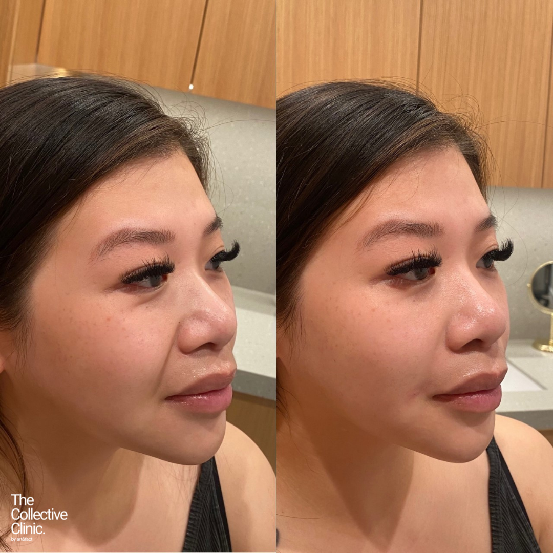 Smile Line Filler — The Collective Clinic