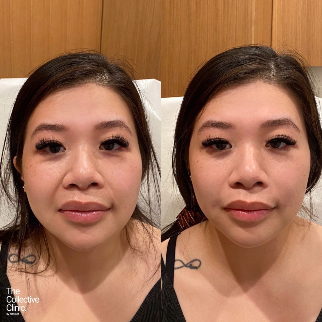 Smile Line Filler — The Collective Clinic