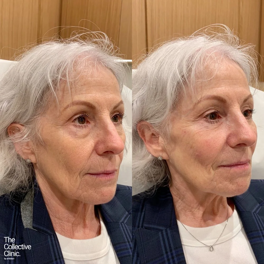 Cheek Filler — The Collective Clinic