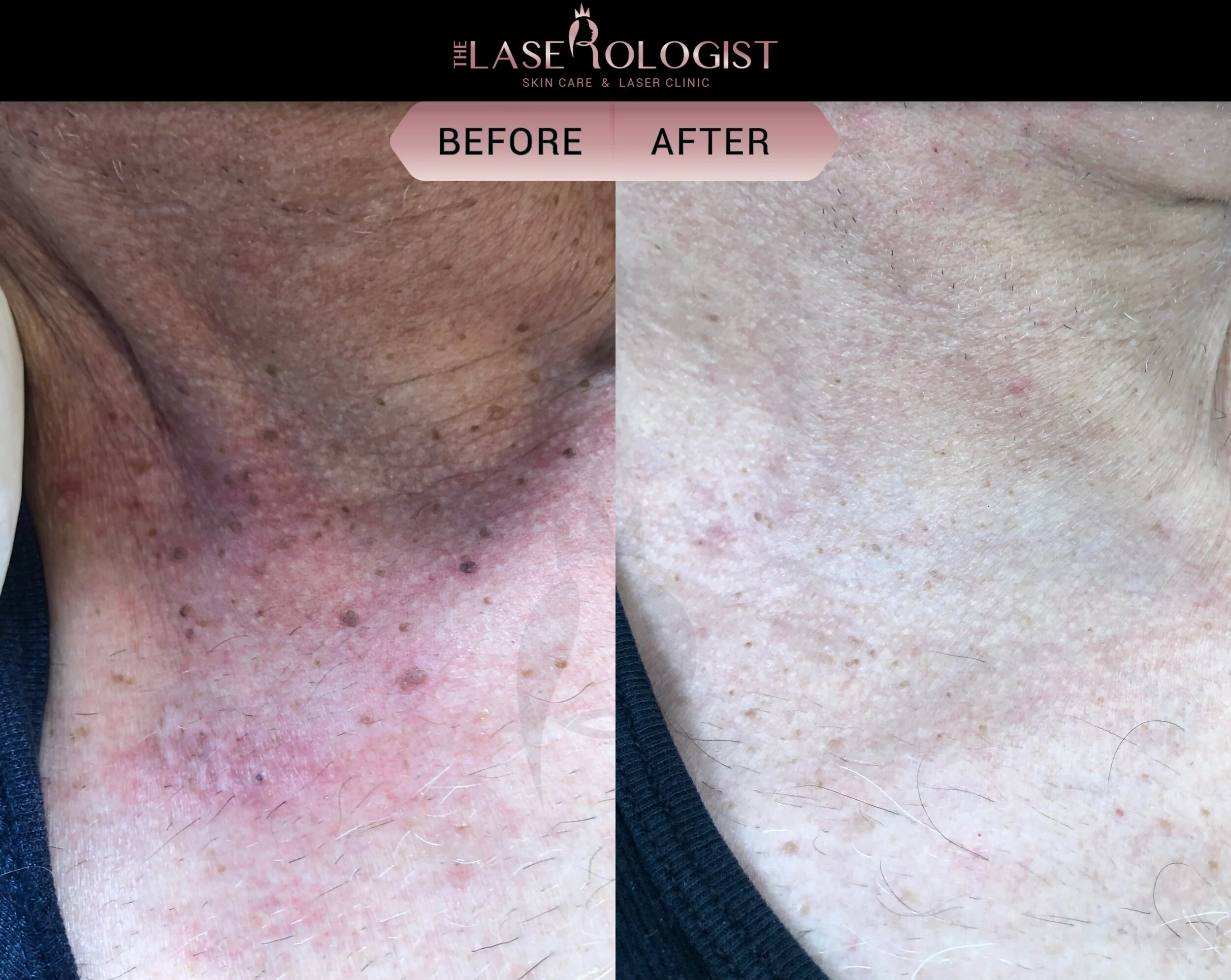 Benign Pigmented Lesion — The Laserologist
