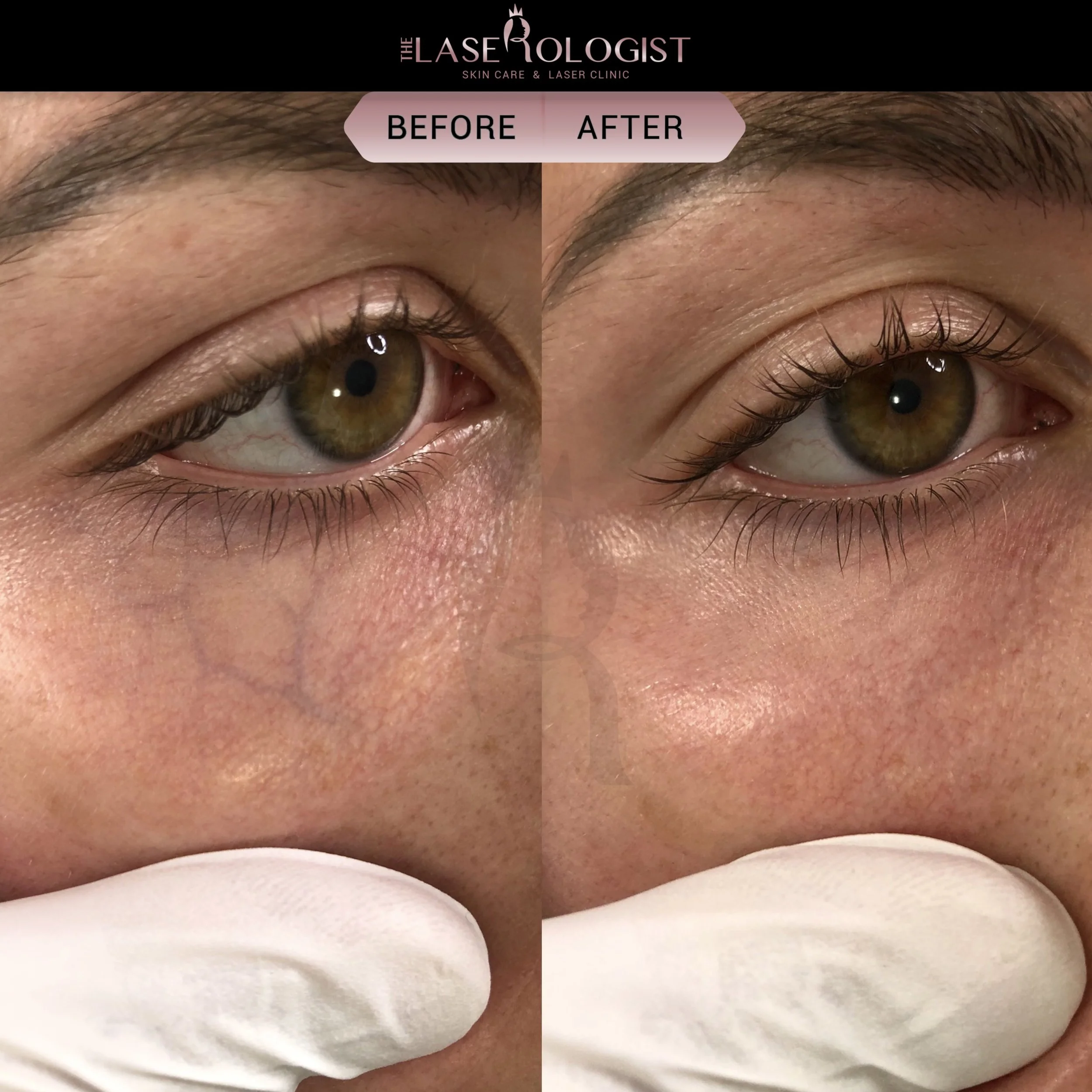 Periorbital Veins — The Laserologist