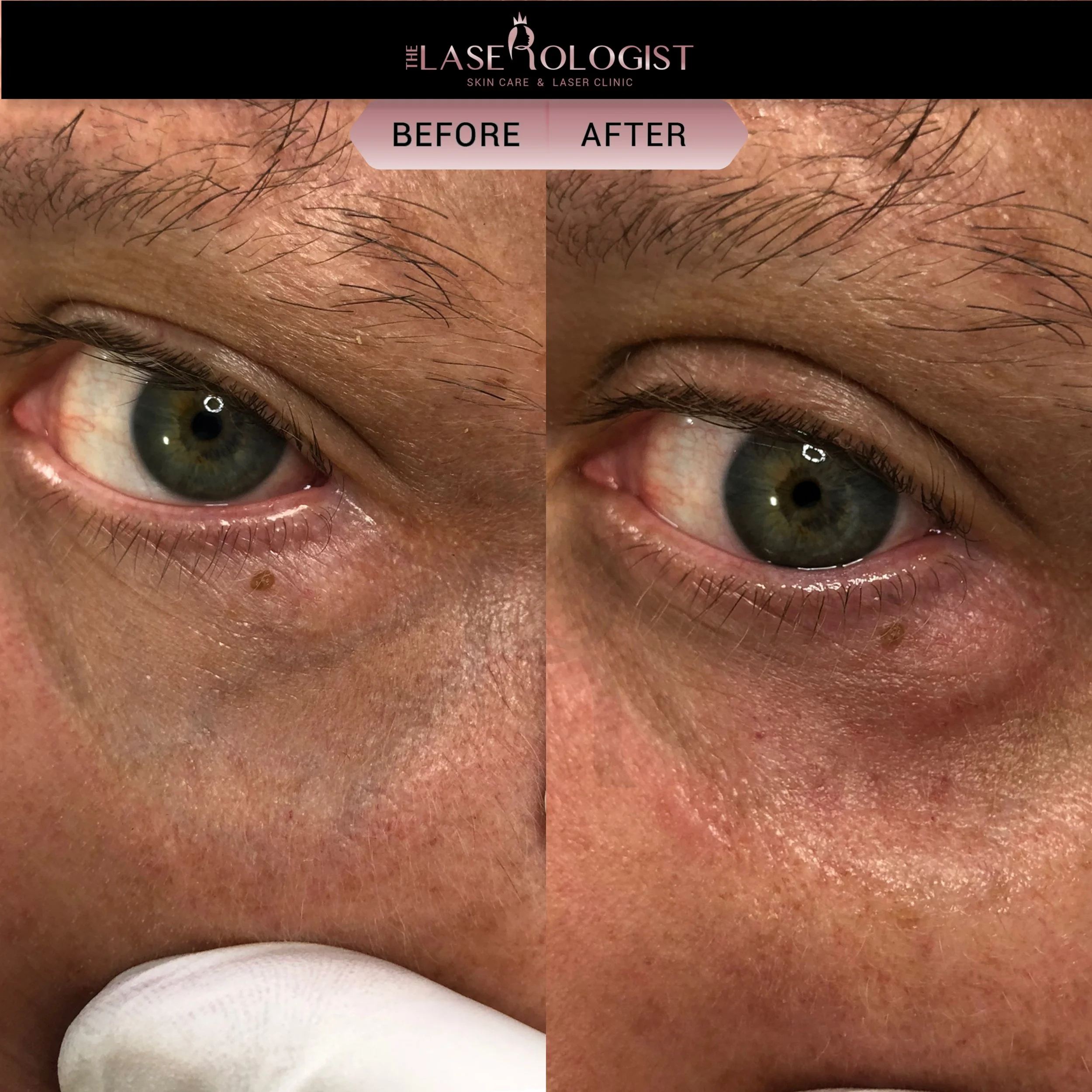 Periorbital Veins — The Laserologist