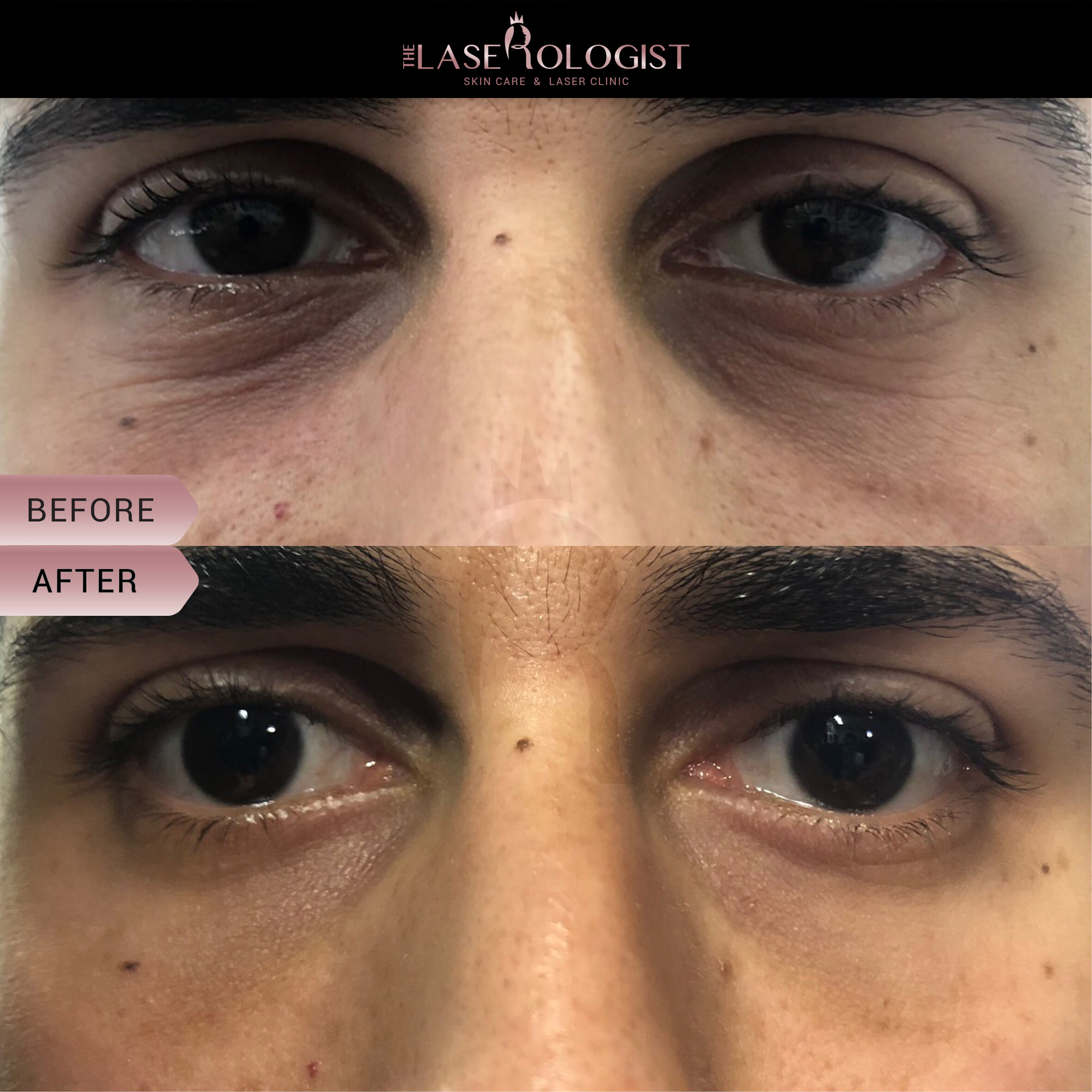 Madonna Eye Lift — The Laserologist Madonna Eye Lift — The Laserologist