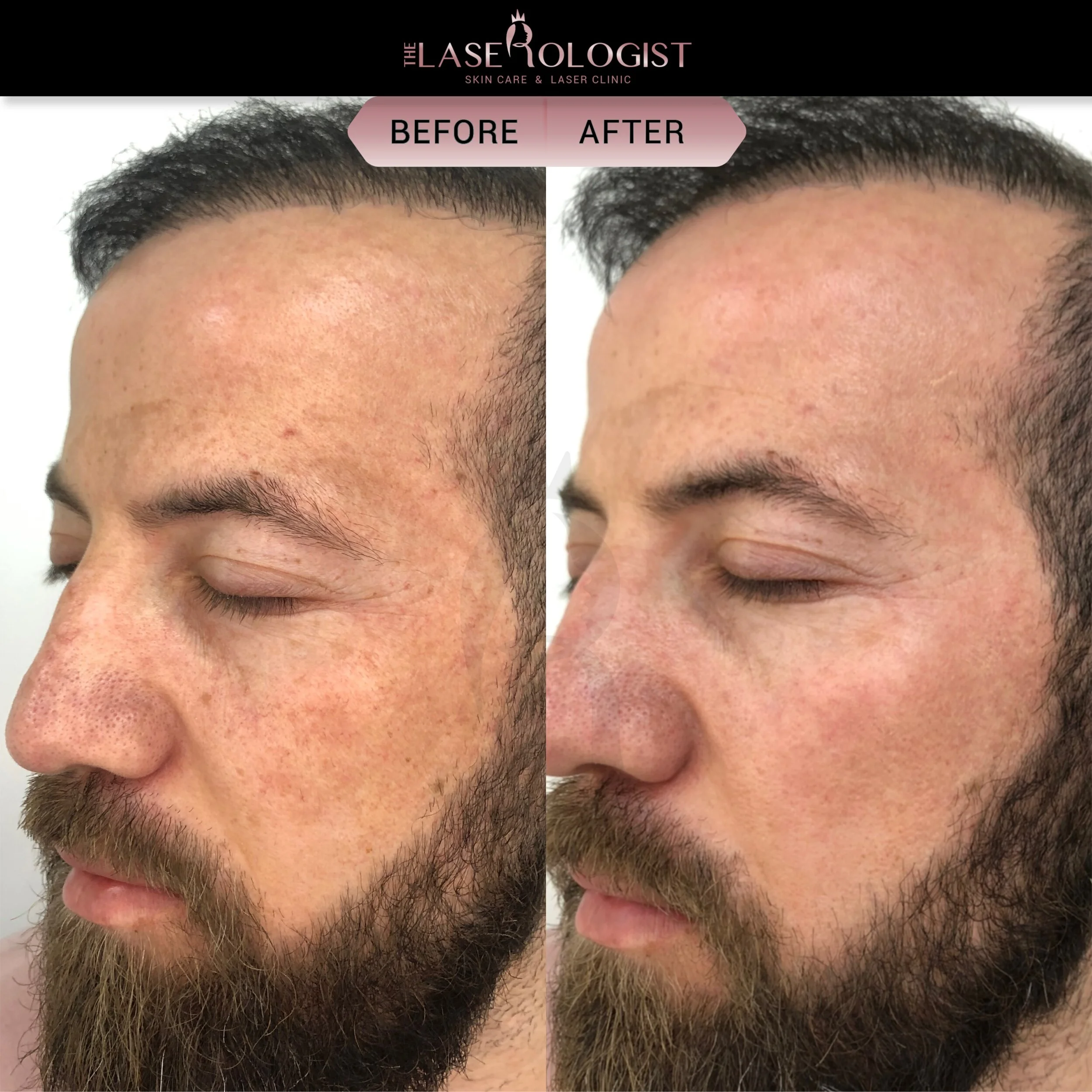 Frax Skin Resurfacing — The Laserologist