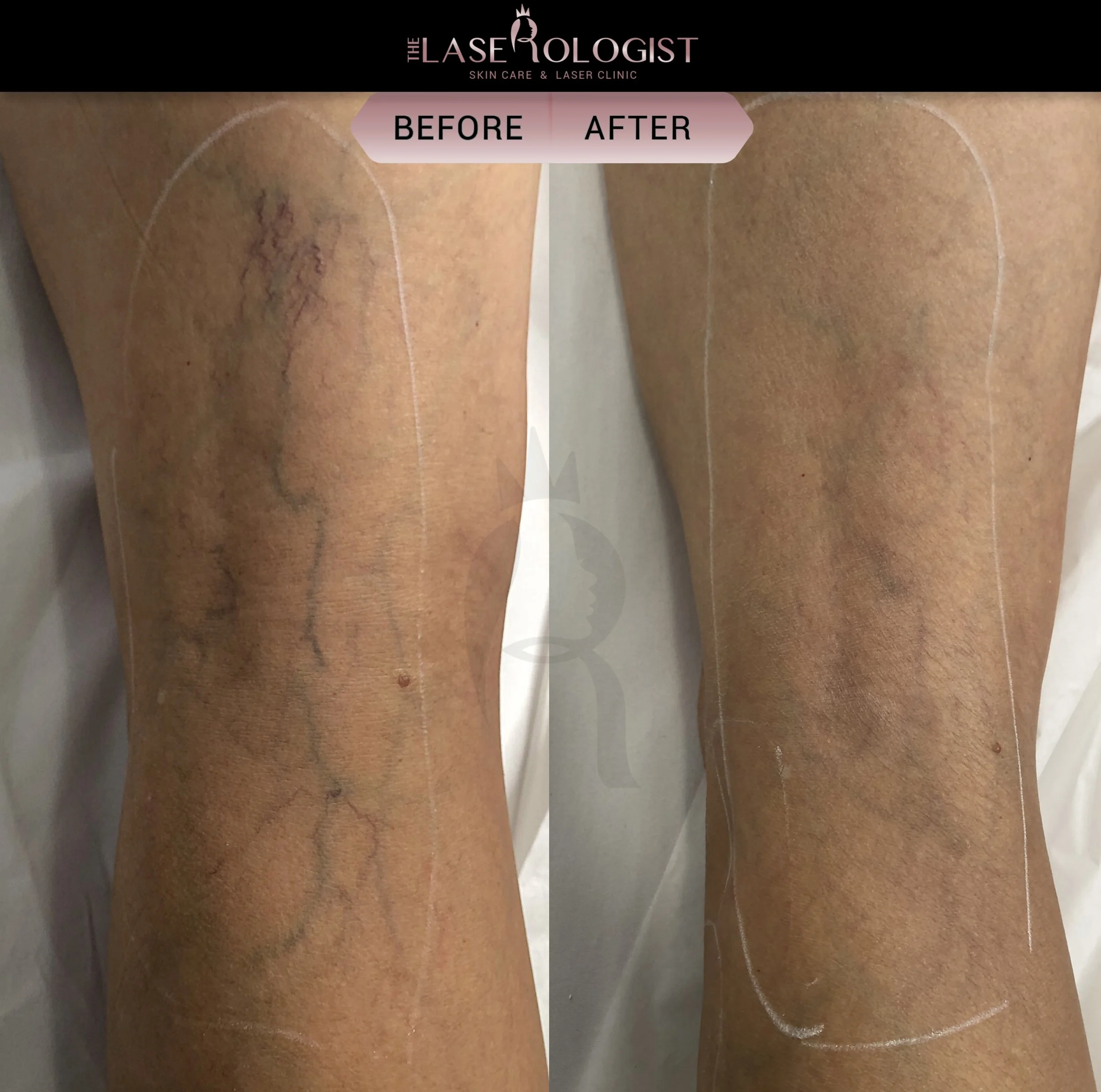 Leg Spider Veins Removal — The Laserologist