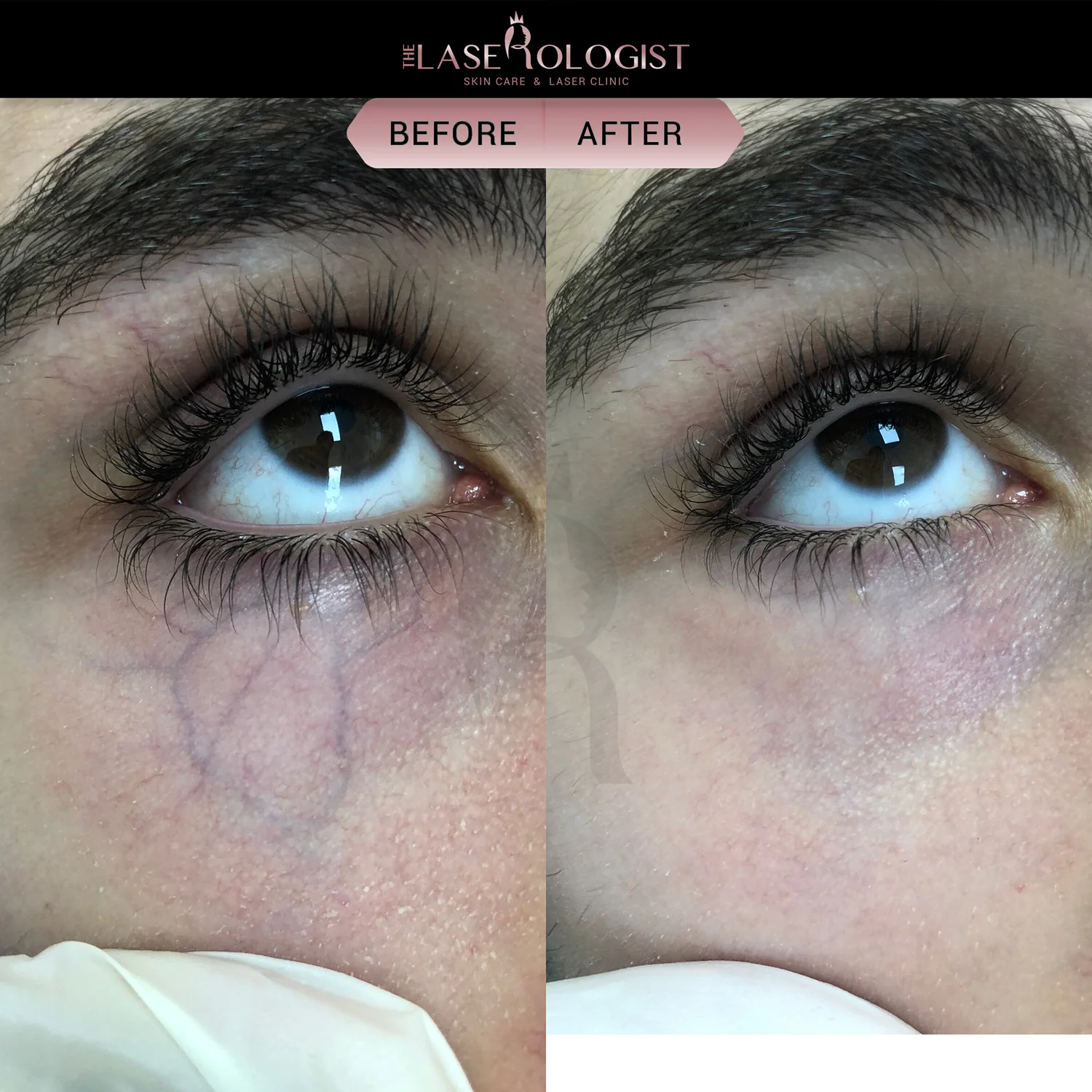 Periorbital Veins — The Laserologist