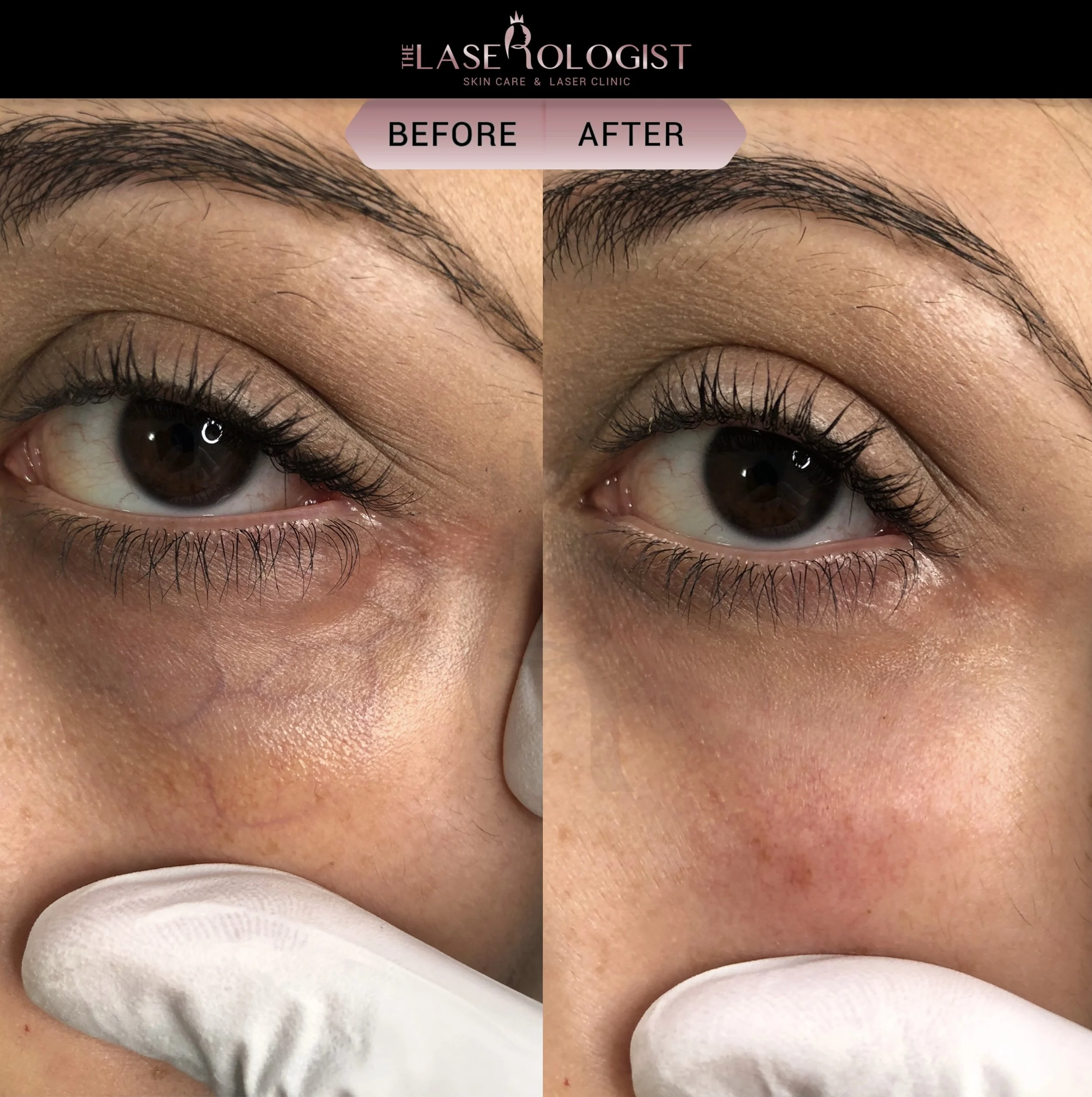 Periorbital Veins — The Laserologist