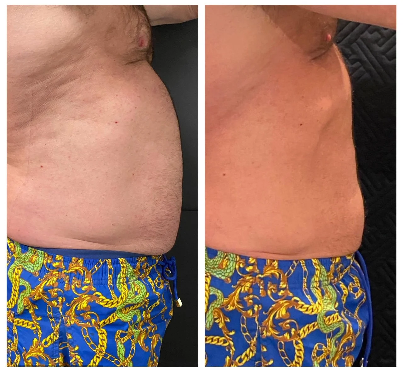 Apolosculpt Body Sculpting Services That Work | Park Place Spa and Body ...