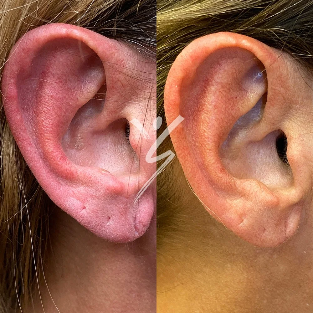 Earlobe Repair | Restore Your Look Today — About Faces Cosmetic Surgery ...