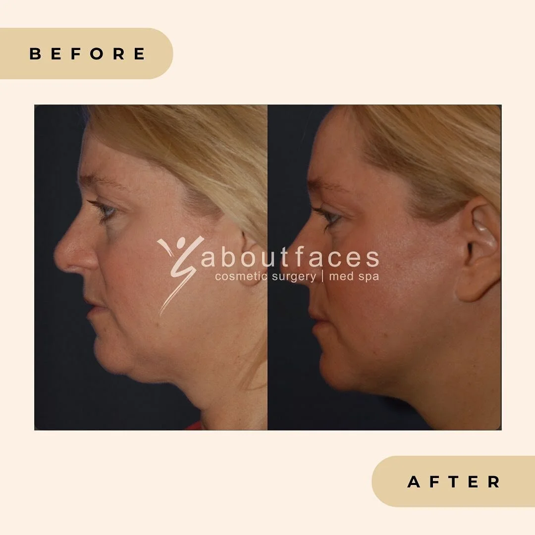 Facial Fat Transfer — About Faces Cosmetic Surgery and Med Spa