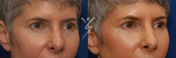 Fat Transfer Gallery | Discover Your Transformation Now — About Faces ...