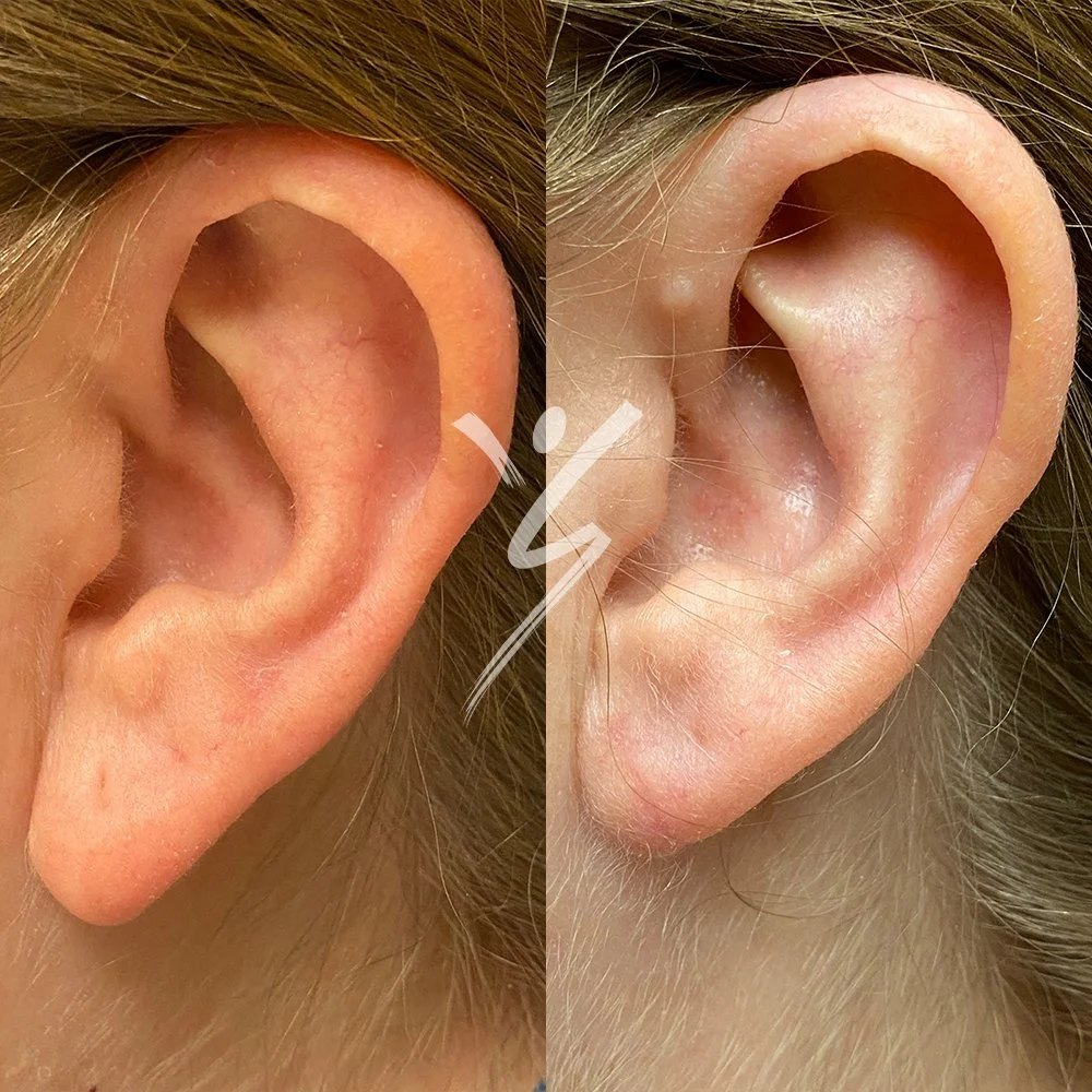 Earlobe Repair | Restore Your Look Today — About Faces Cosmetic Surgery ...