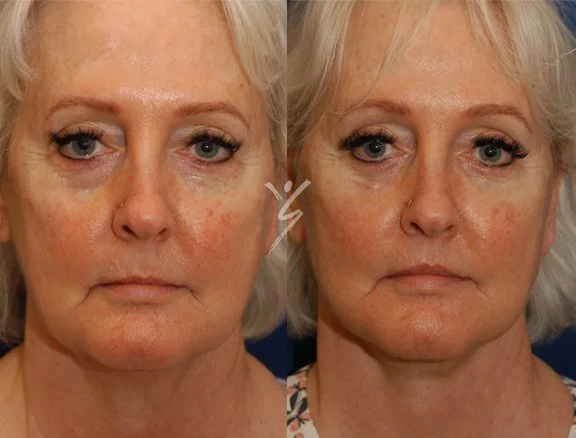 Fat Transfer Gallery | Discover Your Transformation Now — About Faces ...