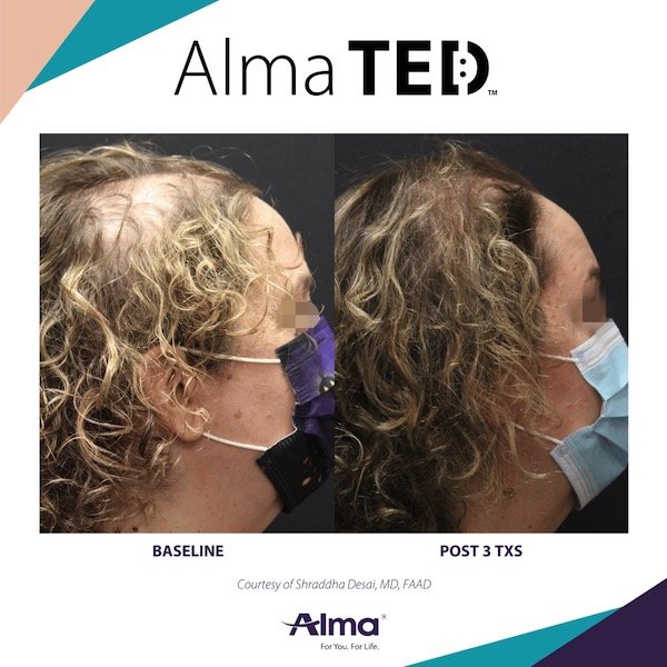 Alma TED Hair Restoration | Restore Hair Today - Schedule a ...