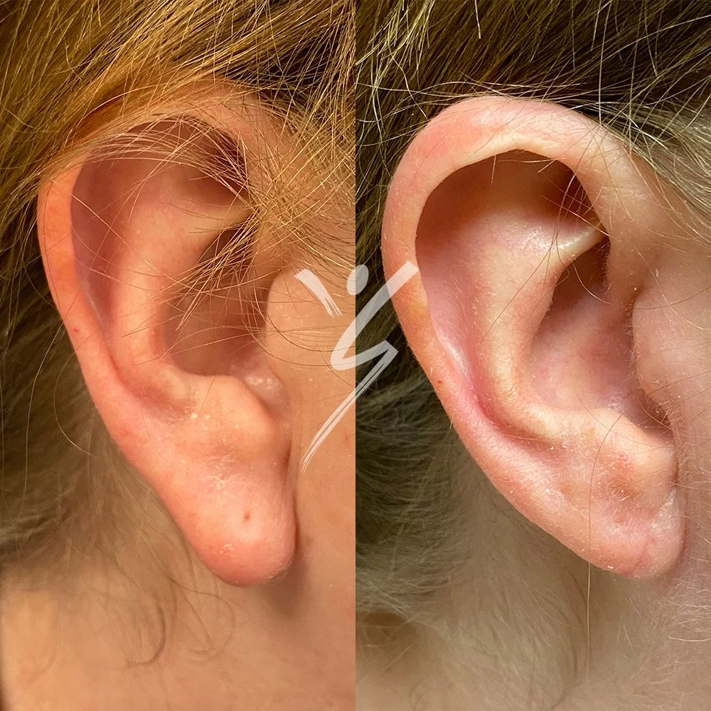 Earlobe Repair | Restore Your Look Today — About Faces Cosmetic Surgery ...