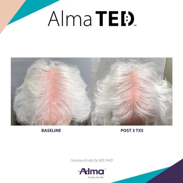 Alma TED Hair Restoration | Restore Hair Today - Schedule a ...