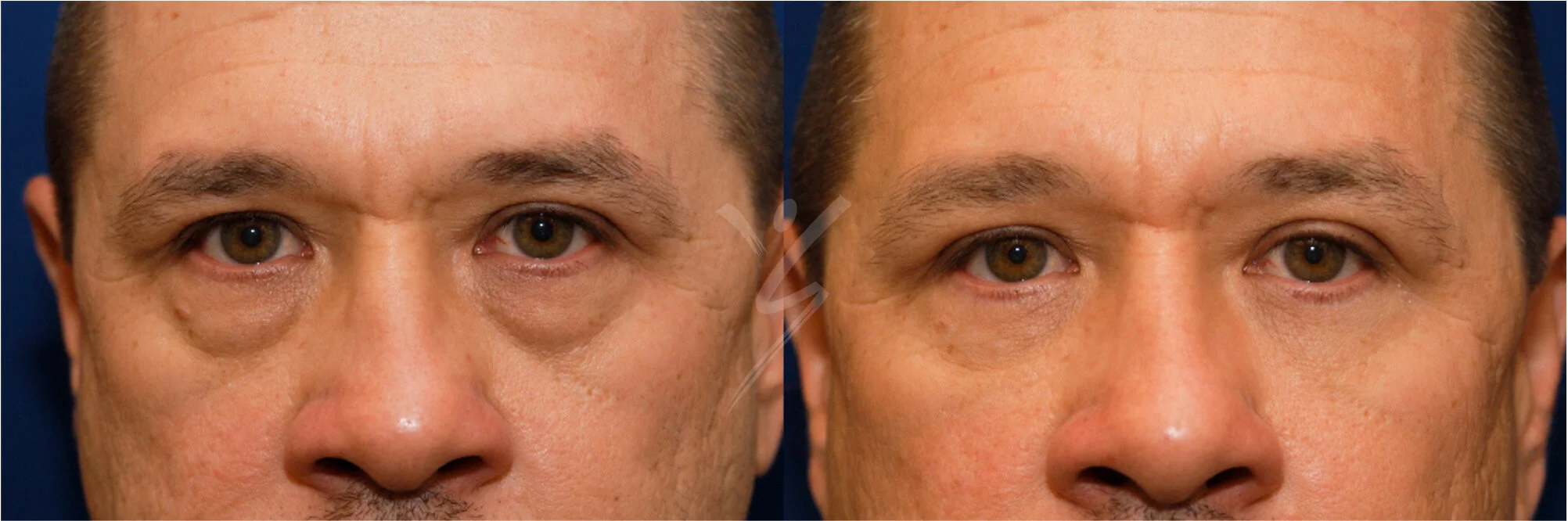 Lower Eyelid Bags | Revitalize Your Eyes – Book Today — About Faces ...