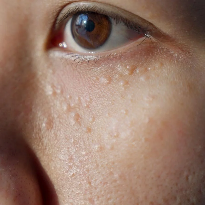 Milia — Fora Dermatology - General & Surgical Dermatology in ...