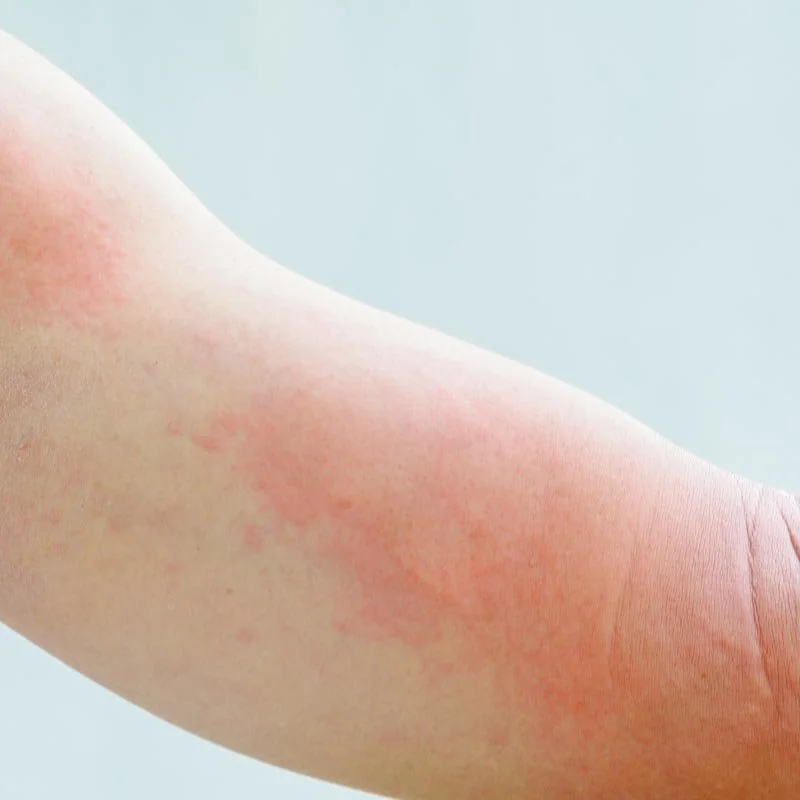 Drug Rashes Fora Dermatology General Surgical Dermatology In Drug Rashes Fora Dermatology General Surgical Dermatology In