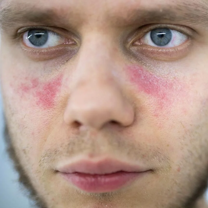 Lupus of the skin — Fora Dermatology - General & Surgical Dermatology ...