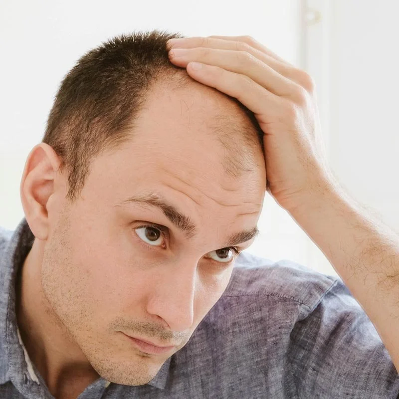 Baldness (male pattern) | Explore Hair Loss Solutions Today — Fora ...