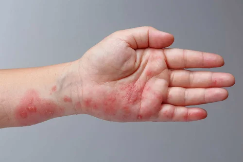 Hand Rash — Fora Dermatology - General & Surgical Dermatology in ...