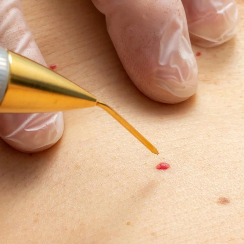 Angiomas — Fora Dermatology - General & Surgical Dermatology in ...