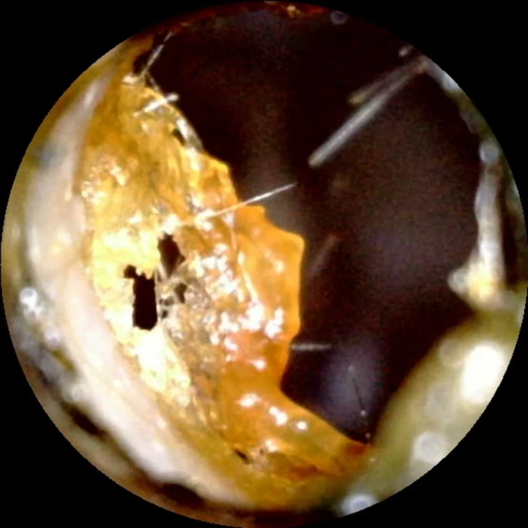 The Colour of Ear Wax & Your Ear Health | Ear View