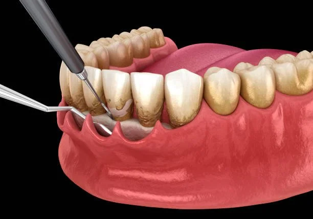 Periodontal Surgical Root Planing | Auckland Central, West, South ...