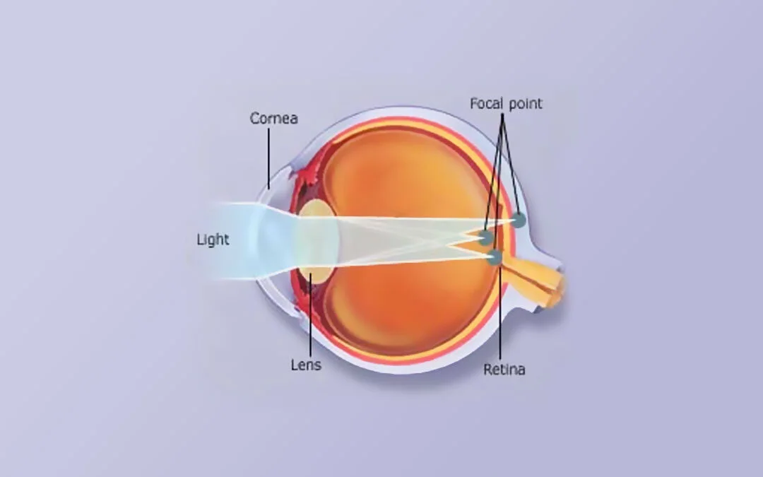 Astigmatism – Blurred Vision and Tired Eyes | Crawshaw Opticians and ...