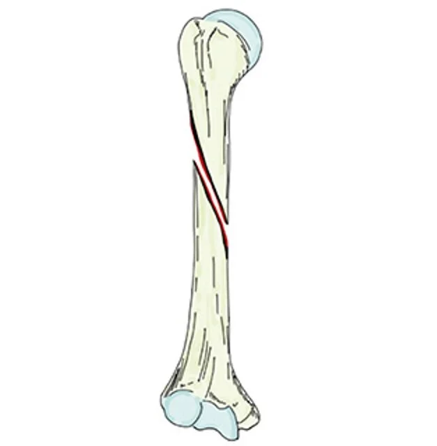 Mid-shaft Humerus Fracture Treatment