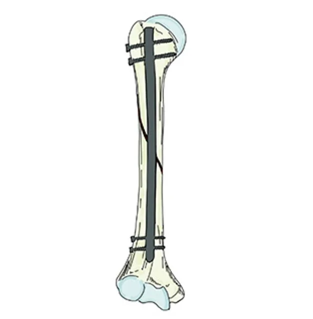 Mid-shaft Humerus Fracture Treatment