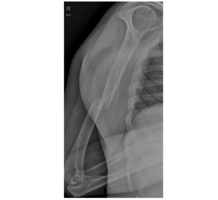 Mid-shaft Humerus Fracture Treatment