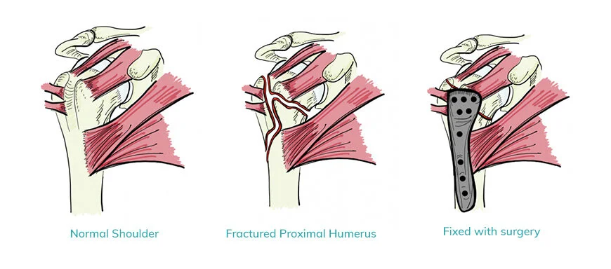 Fractured Shoulder Treatment