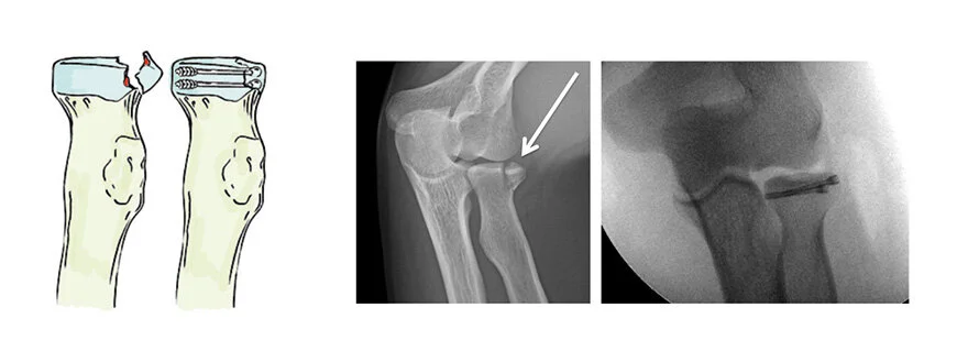 Radial Head Fracture Treatment