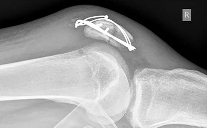 Patella Fracture and Treatment