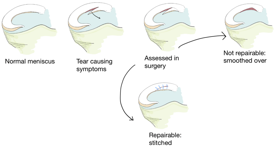 General Information: Meniscal Injuries of the Knee