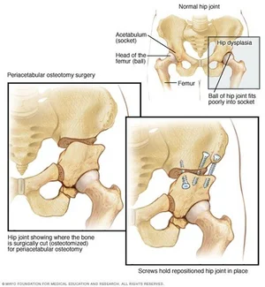Periacetabular Osteotomy (PAO) Handbook and Pathway