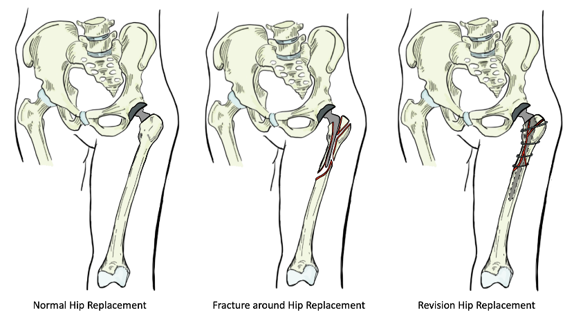 Periprosthetic Hip Fracture Treatment