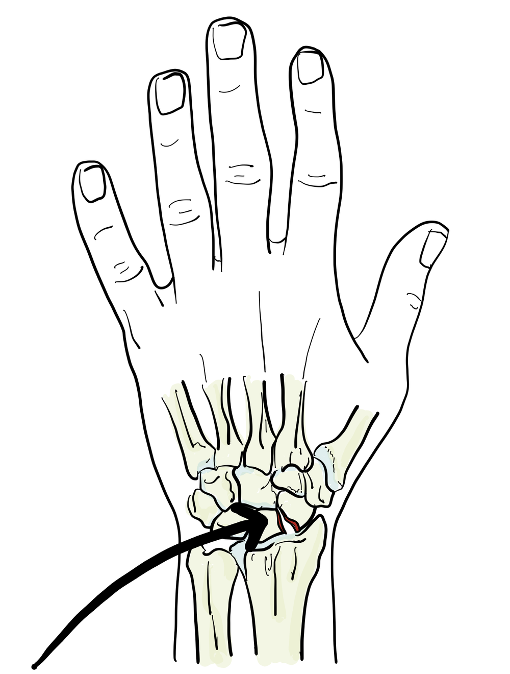 Scaphoid Fractures