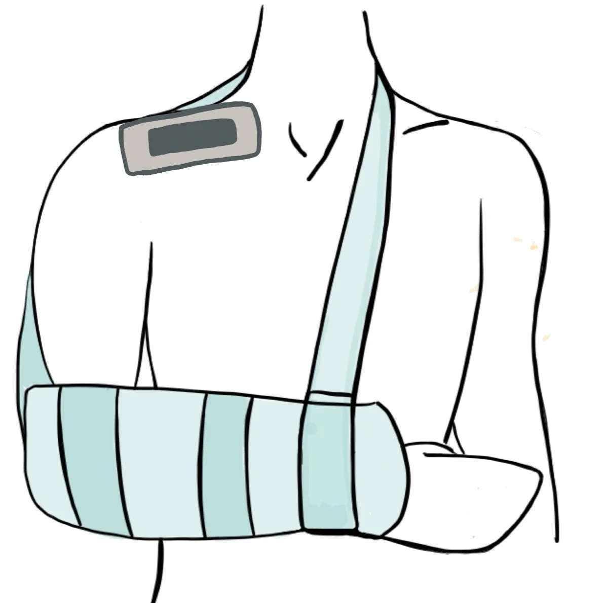 Removal of Clavicle Plate: Post-Operative Care